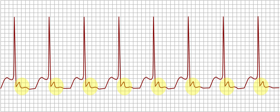 What is Ventricular Tachycardia (VT)? - Revere Health